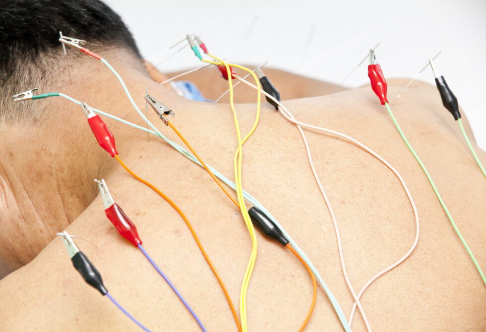 Electro Acupuncture | Pain Relief & Healing